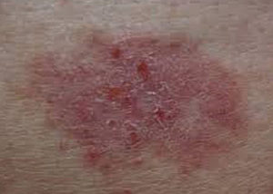 Basal Cell Carcinoma (BCC) | Spotscreen